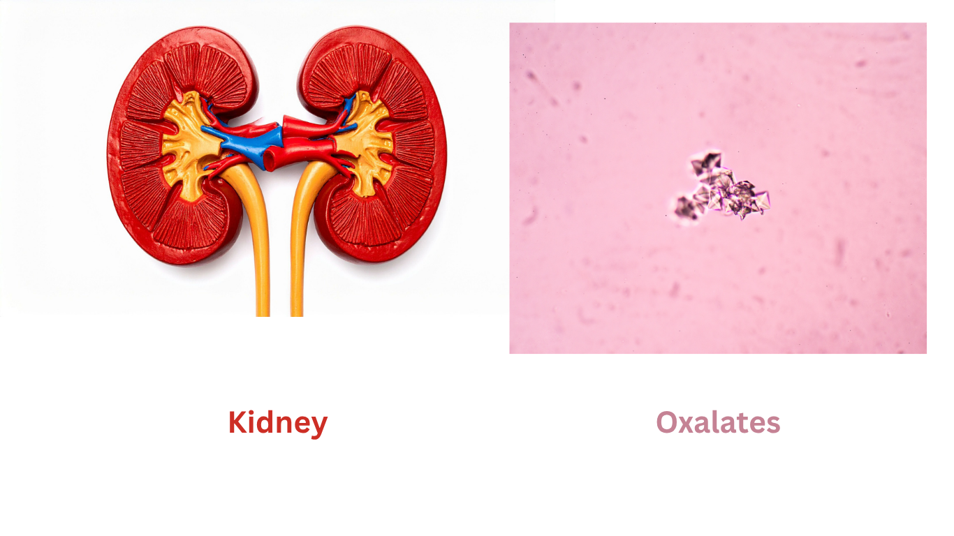 💧 Kidney Stones vs Oxalates: Understanding the Connection – Yarima